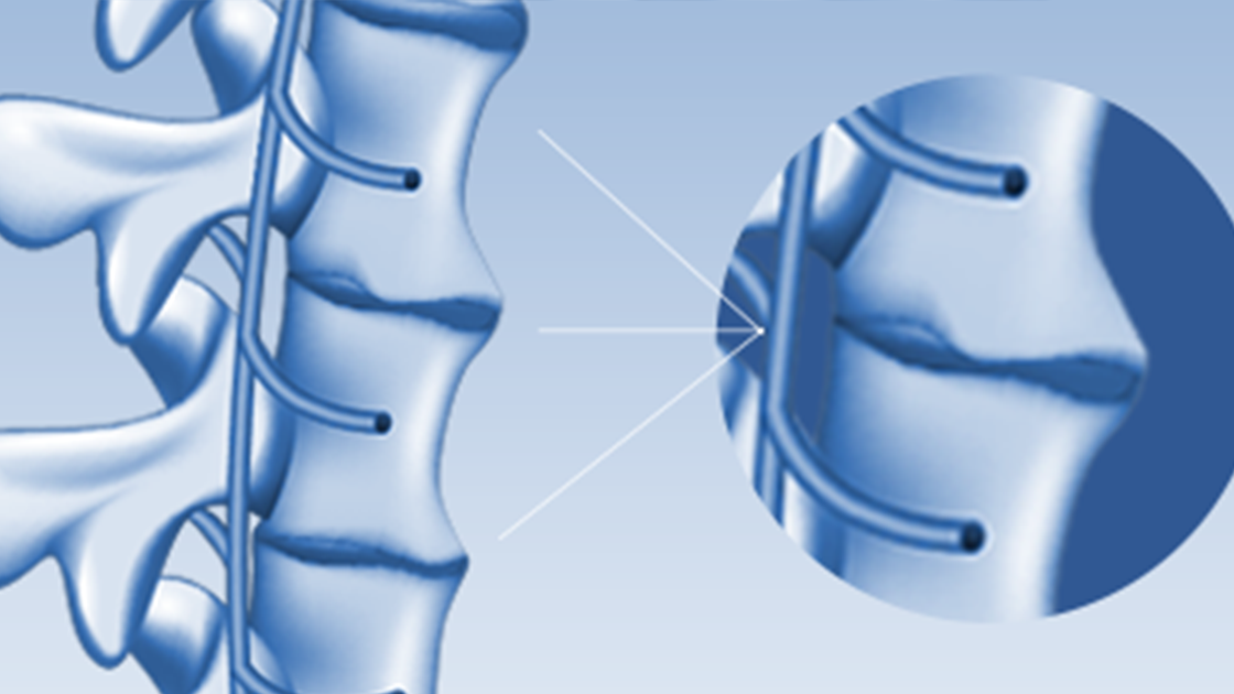 Spine Fusion Treatment | 360 Spine Fusion | Fusion Surgery