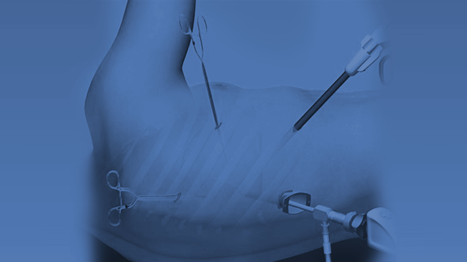 VATS Sympathectomy - VATS Sympathectomy for Hyperhidrosis