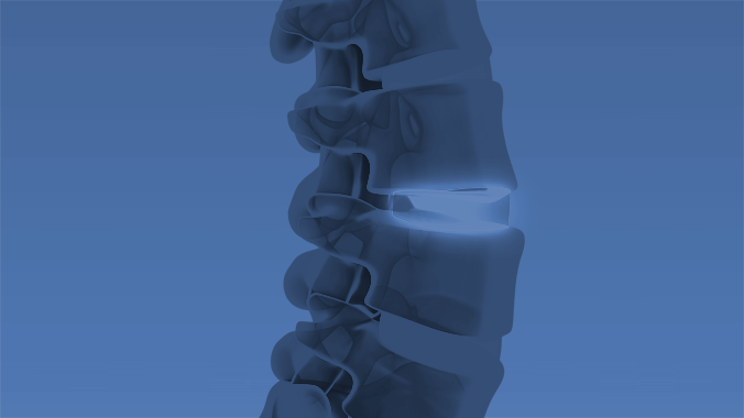 Total Disc Replacement Surgery | Cervical and Lumbar TDR Surgeon